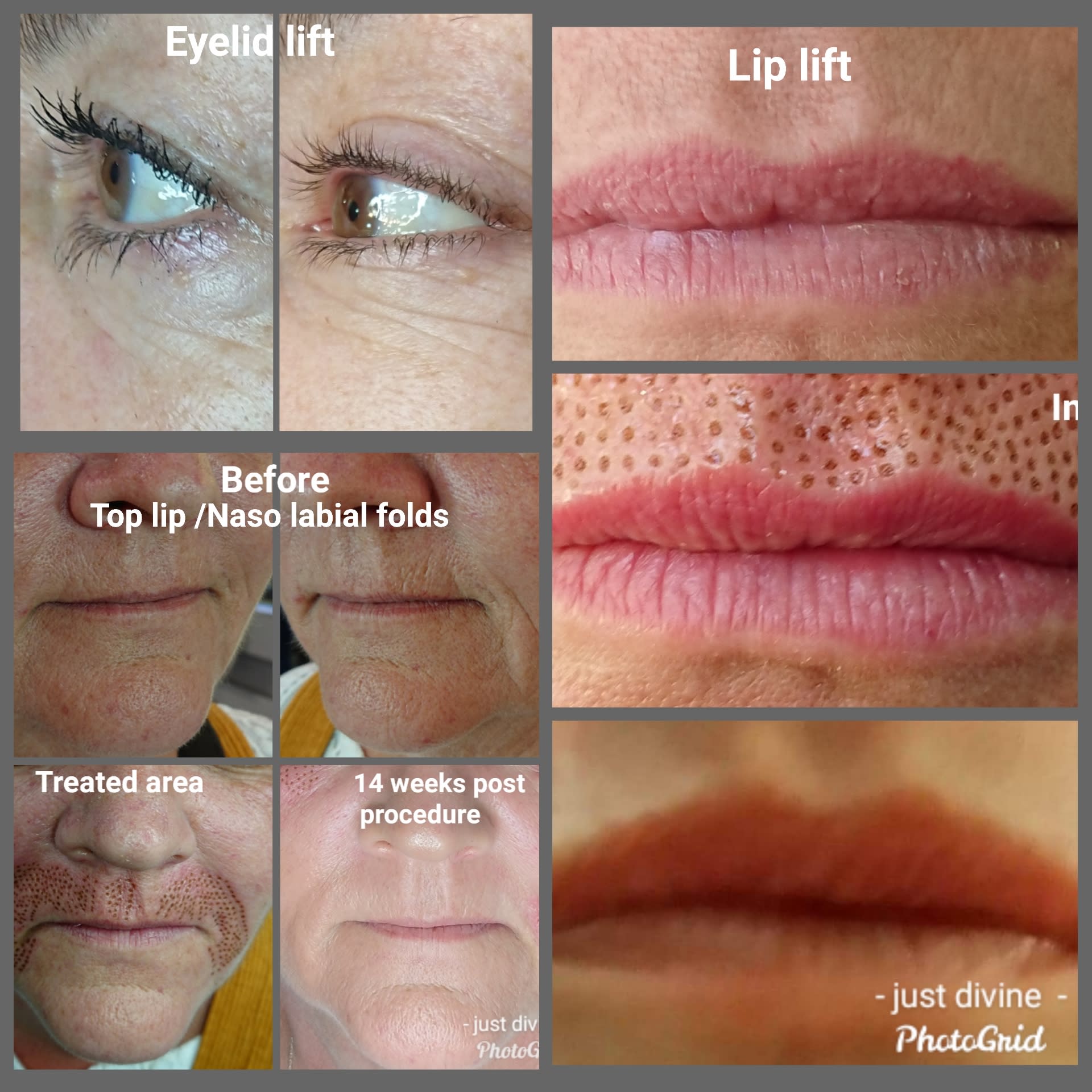 Dermo Plasma - Beauty Treatments - Just Divine - Hair And Beauty Salon ...