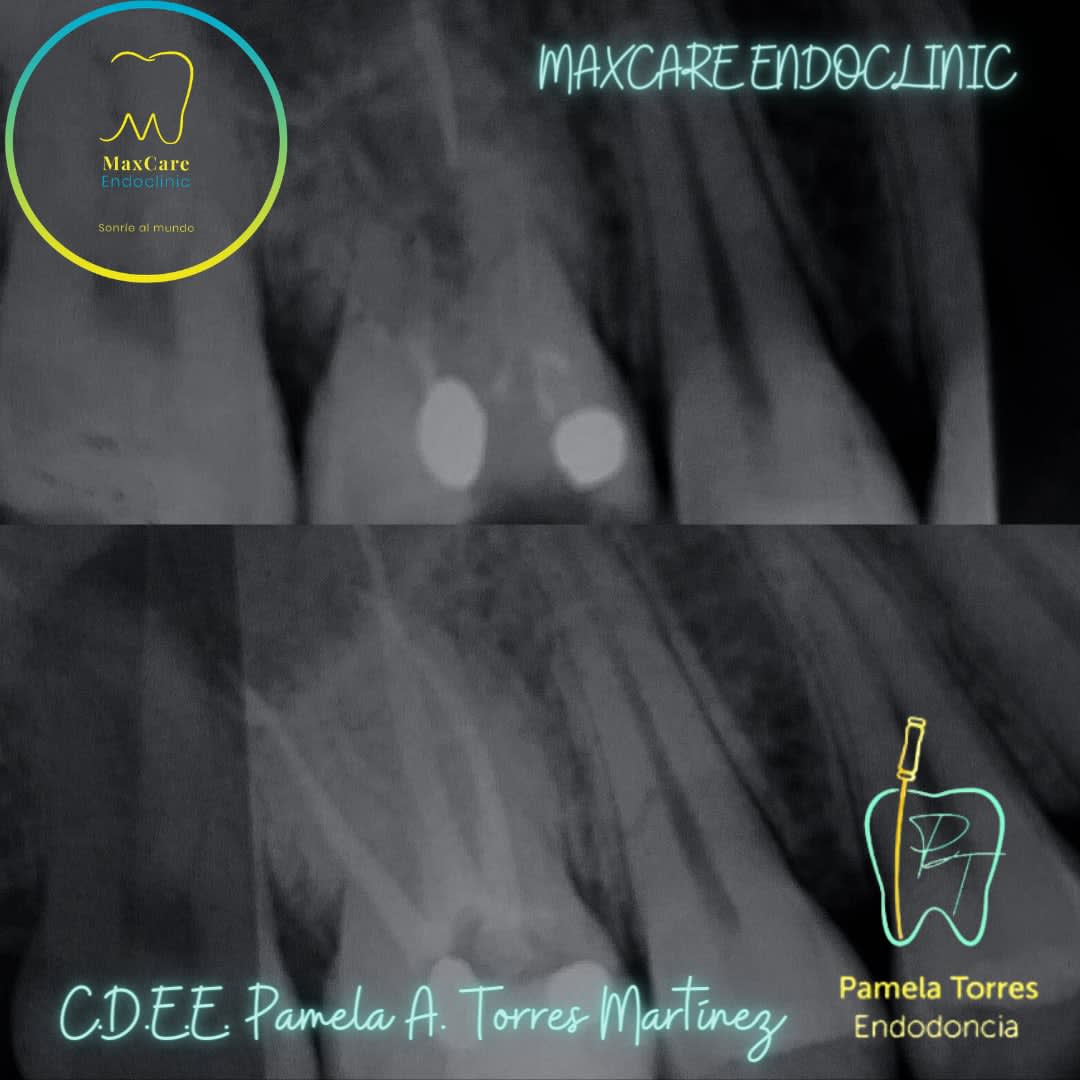 RETRATAMIENTO - TRATAMIENTOS - Maxcare Endoclinic | Consultorio dental ...