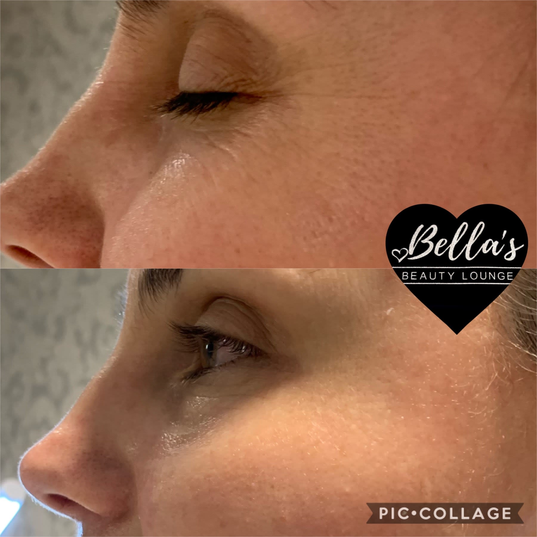 Peel, Dermaplaning & Microneedling - Facial Treatments - Bella Goode ...