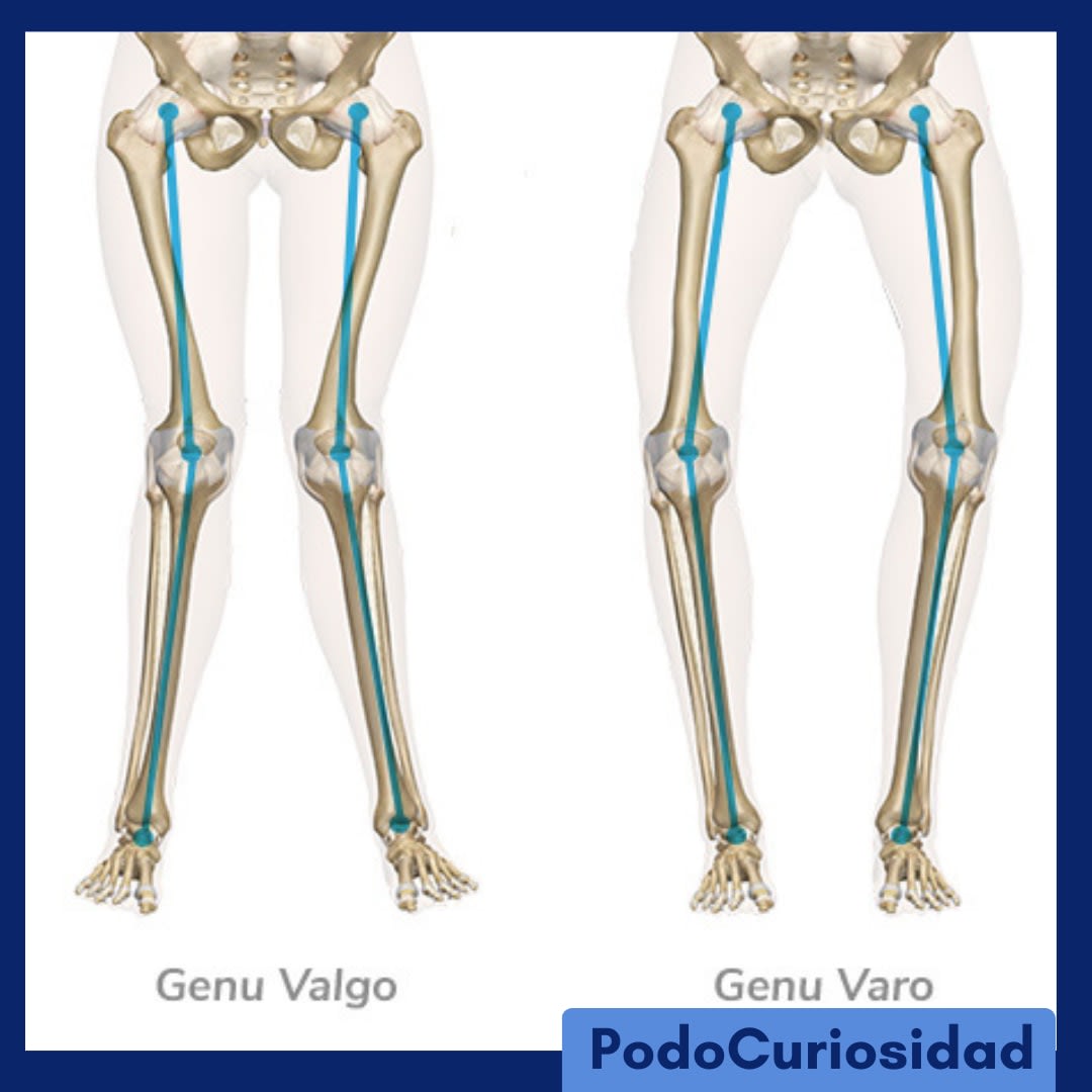 Genu Valgo y Genu Varo. - PodoCuriosidades - Clínica del Pie Ayora ...