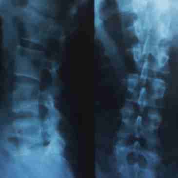 Spondylolithesis - The Spine - Children's Orthopaedic Institute ...