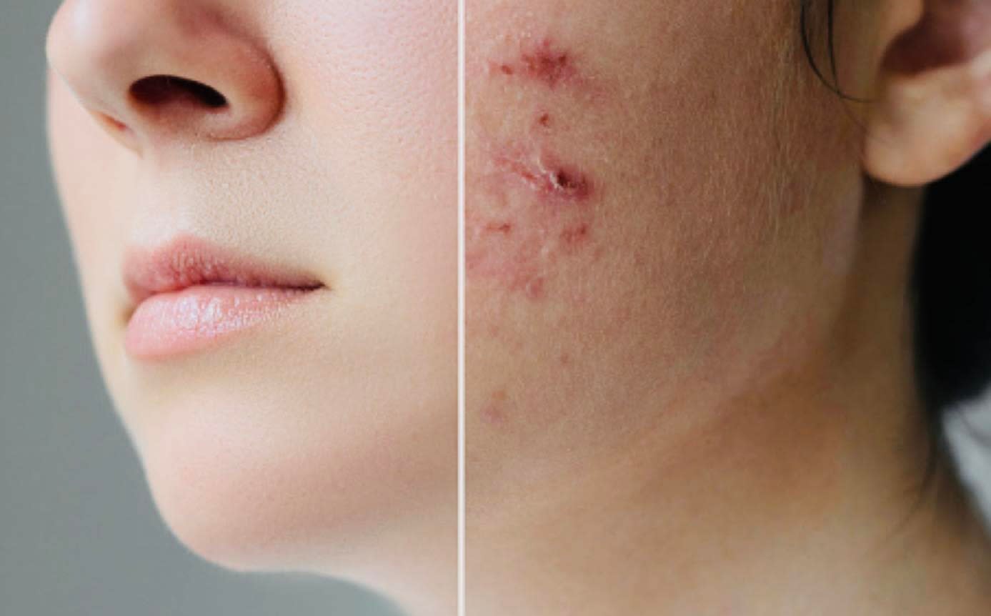 Acne Facial - SKIN SERVICES - Beautiful U Skin Studio | Vadnais Heights