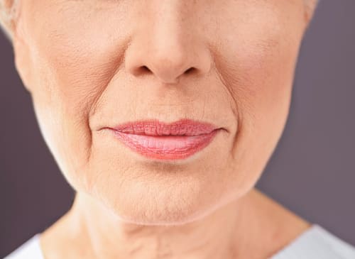Nasolabial Fold (Smile Line) - Derma Fillers - Galka Aesthetic | Facial ...