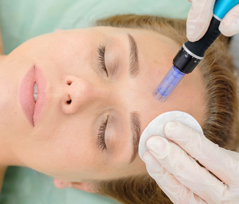 5 Micro-Needling Sessions - Packages - Skin Addict | Skin Care & Weight ...