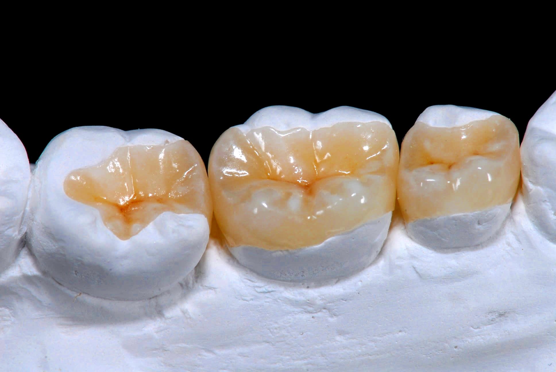 Inlays and Onlays | Incrustaciones y Recubrimientos Dentales - General ...
