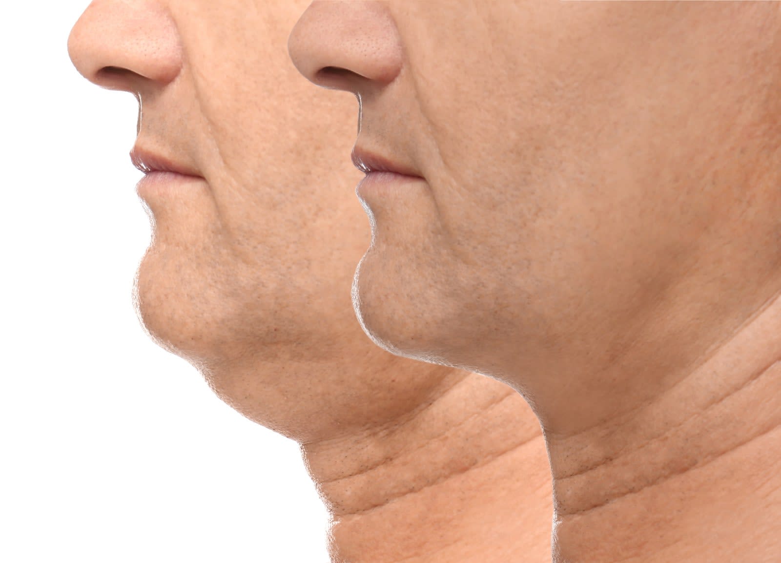 Double Chin - Fat Dissolving - Face-It-Aesthetics | Aesthetics Clinic ...