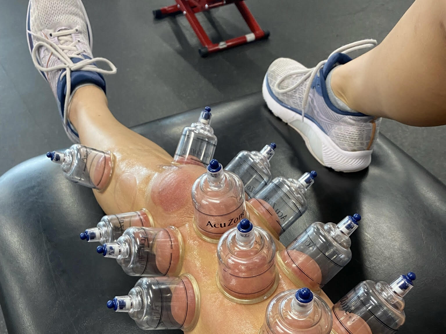 Cupping Available Treatments Peak Performance Sports And Spine CTR