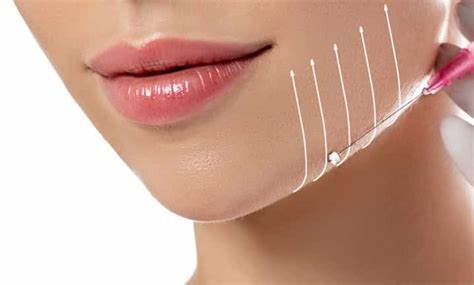 PDO Threads Full Face & Neck - PDO Mono Threads - The Halo Aesthetics ...