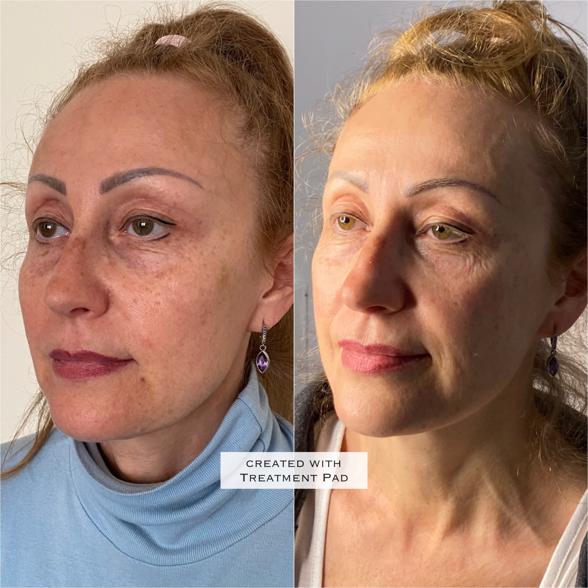 Cheek augmentation - DERMAL FILLERS - Evgenia