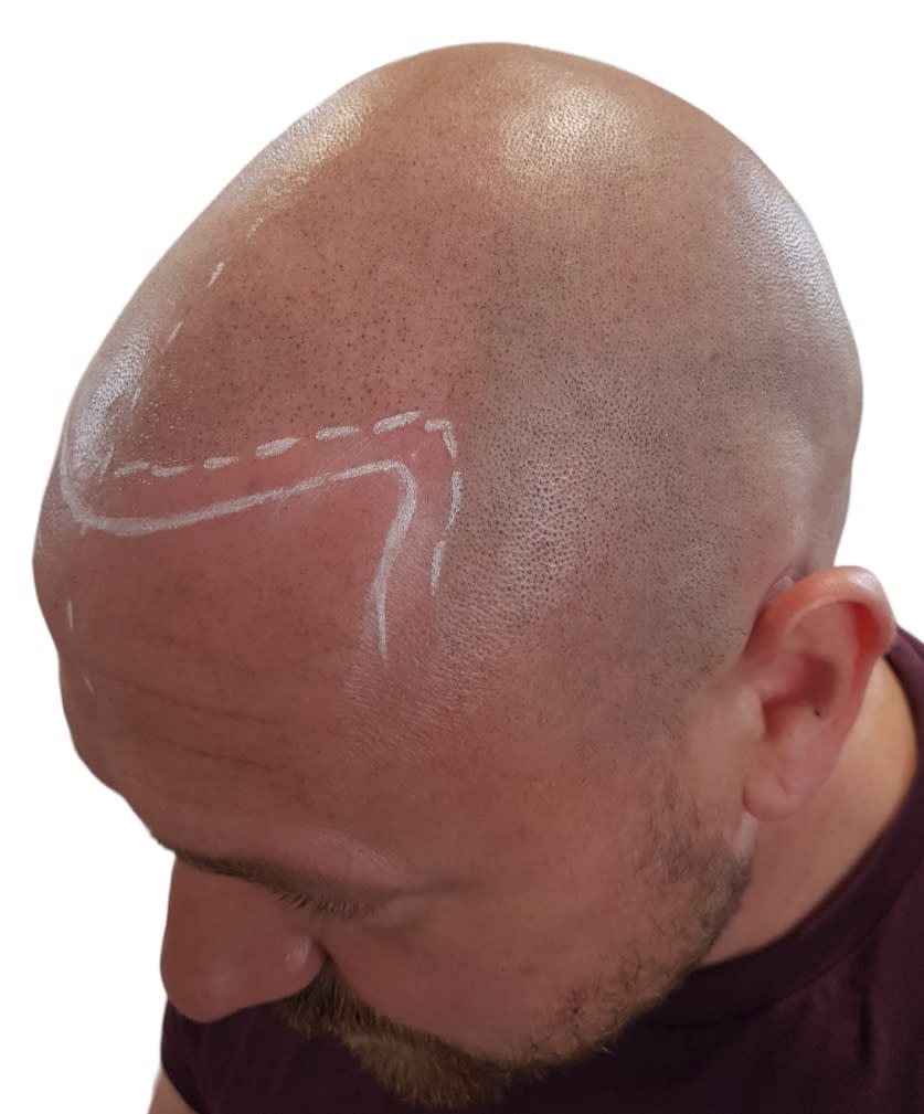 Pattern Baldness - Which one is for you? - Artist's Point | Scalp ...