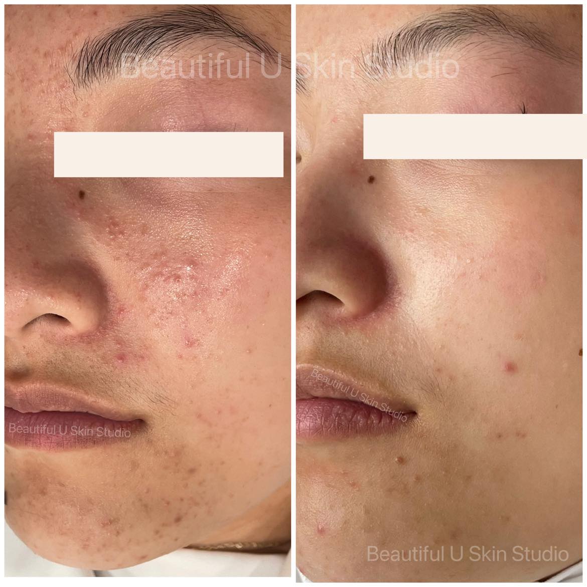 Get Glow Micro-Peel - SKIN SERVICES - Beautiful U Skin Studio | Vadnais ...