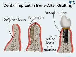 Bone & Tissue Grafting - Dental - Deeply Rooted Dentistry - Root Canal ...