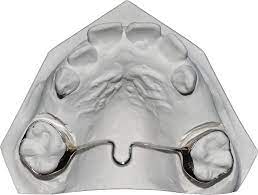 Transpalatal Arch - Space Maintainers & Habit Appliances - Acrylic ...