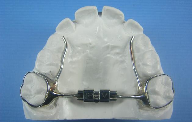 Rapid Palatal Expander - Functional Appliances - Acrylic Designs Dental ...