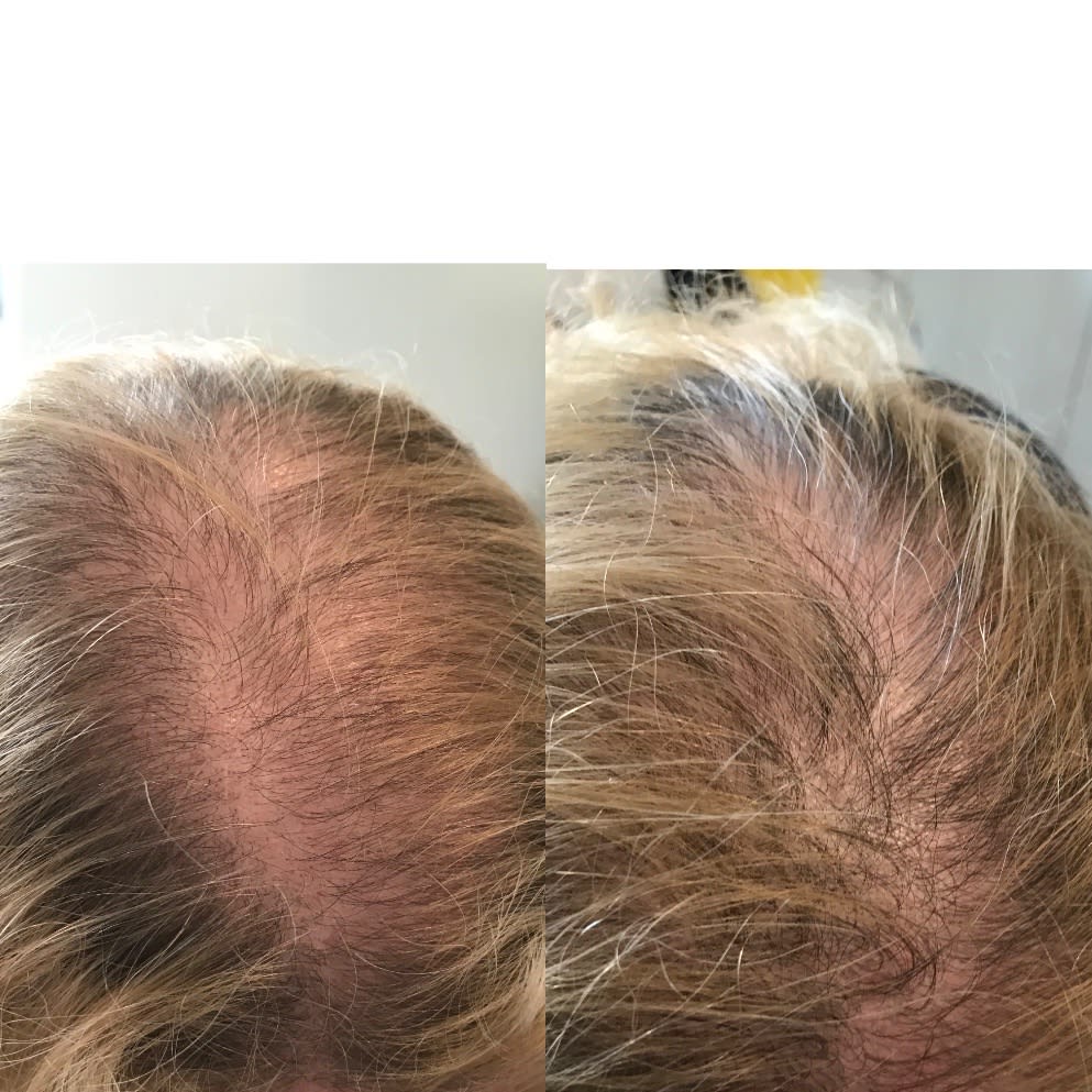 PRP Hair Restoration - Skin Booster & Progressive Facials | Hair ...