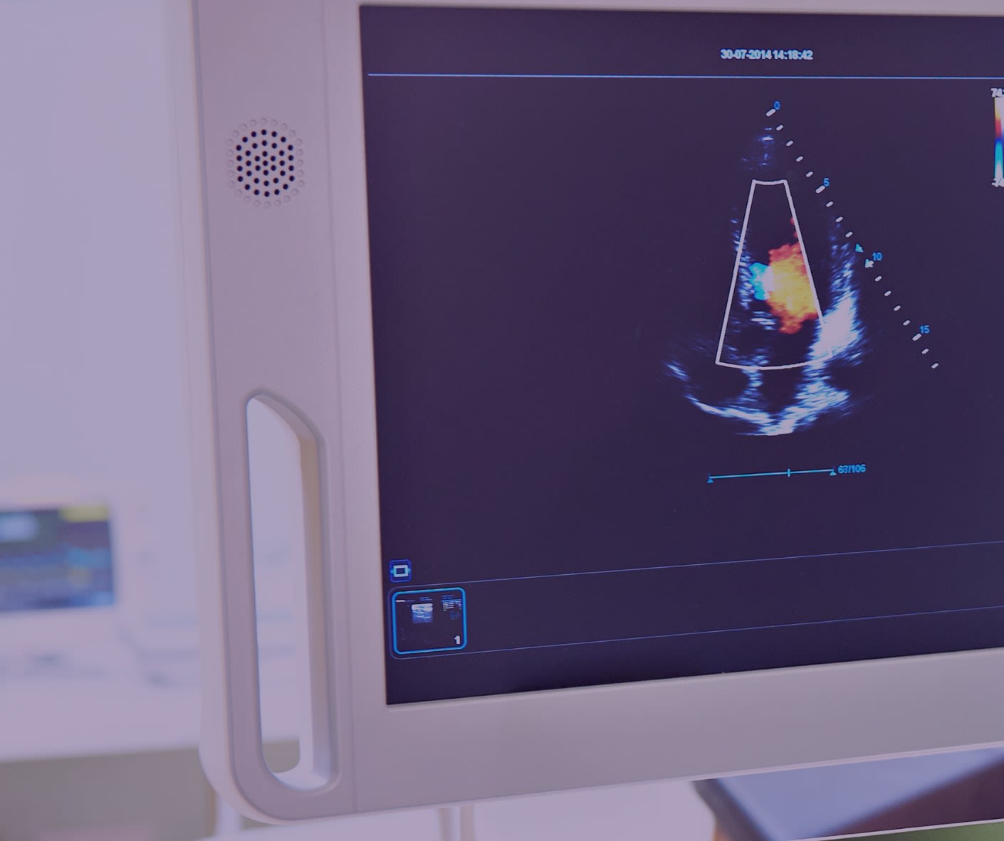 Carotid Duplex Examination - Vascular Ultrasound Services - Allied ...