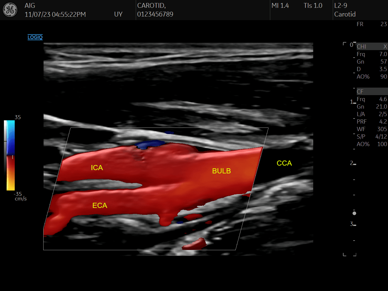 Carotid Duplex Examination - Vascular Ultrasound Services - Allied ...
