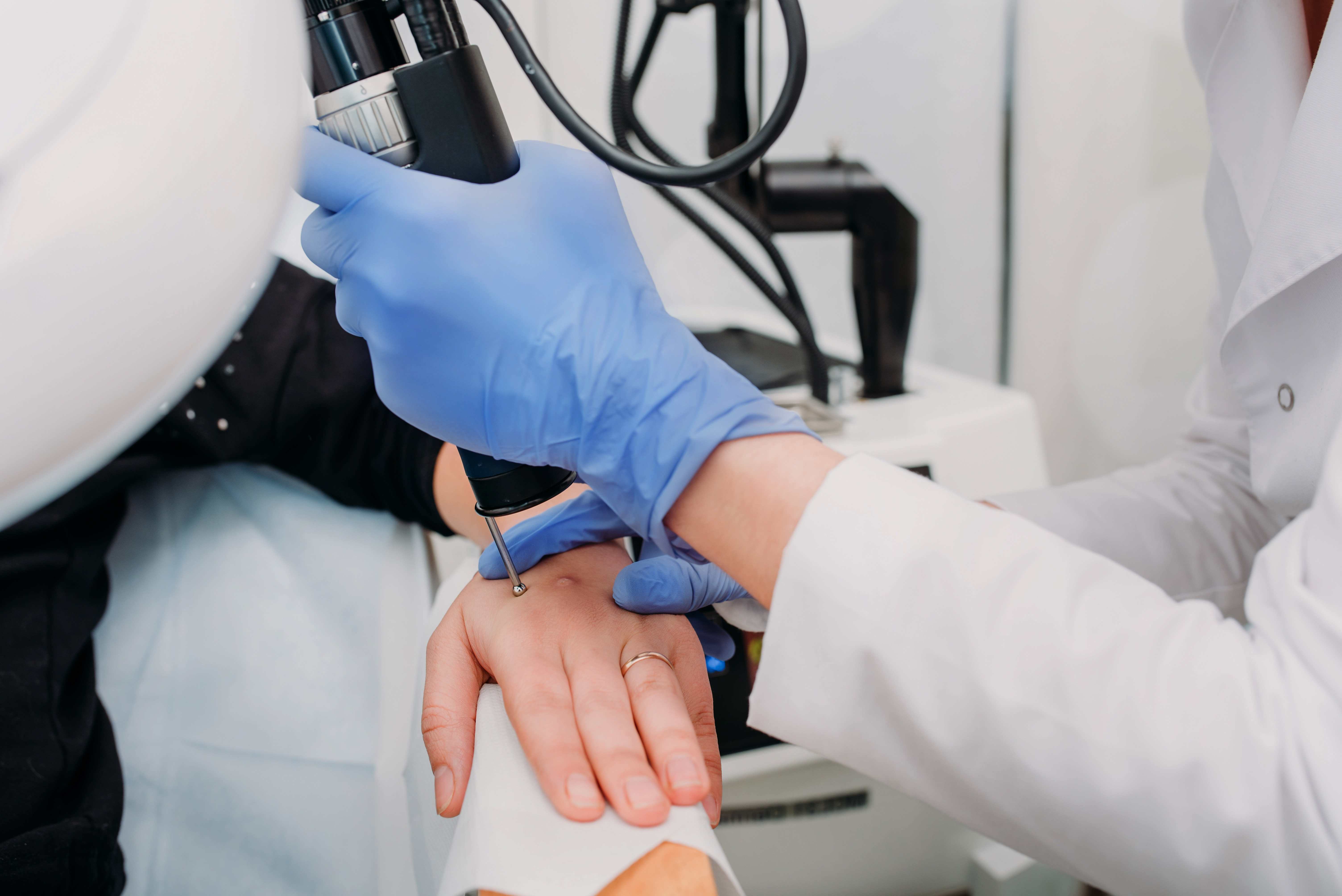 Cryotherapy - Our Specialized Services - London Verruca Clinic - Foot ...