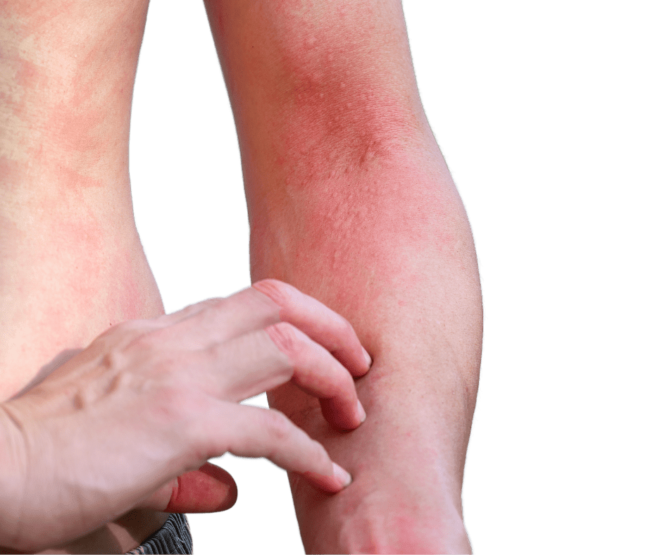 Insect Bites - Medical Dermatology - Unique Dermatology & Wellness ...