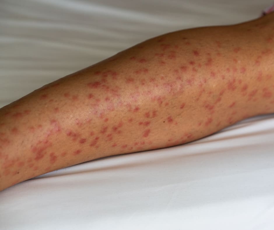 Insect Bites - Medical Dermatology - Unique Dermatology & Wellness ...