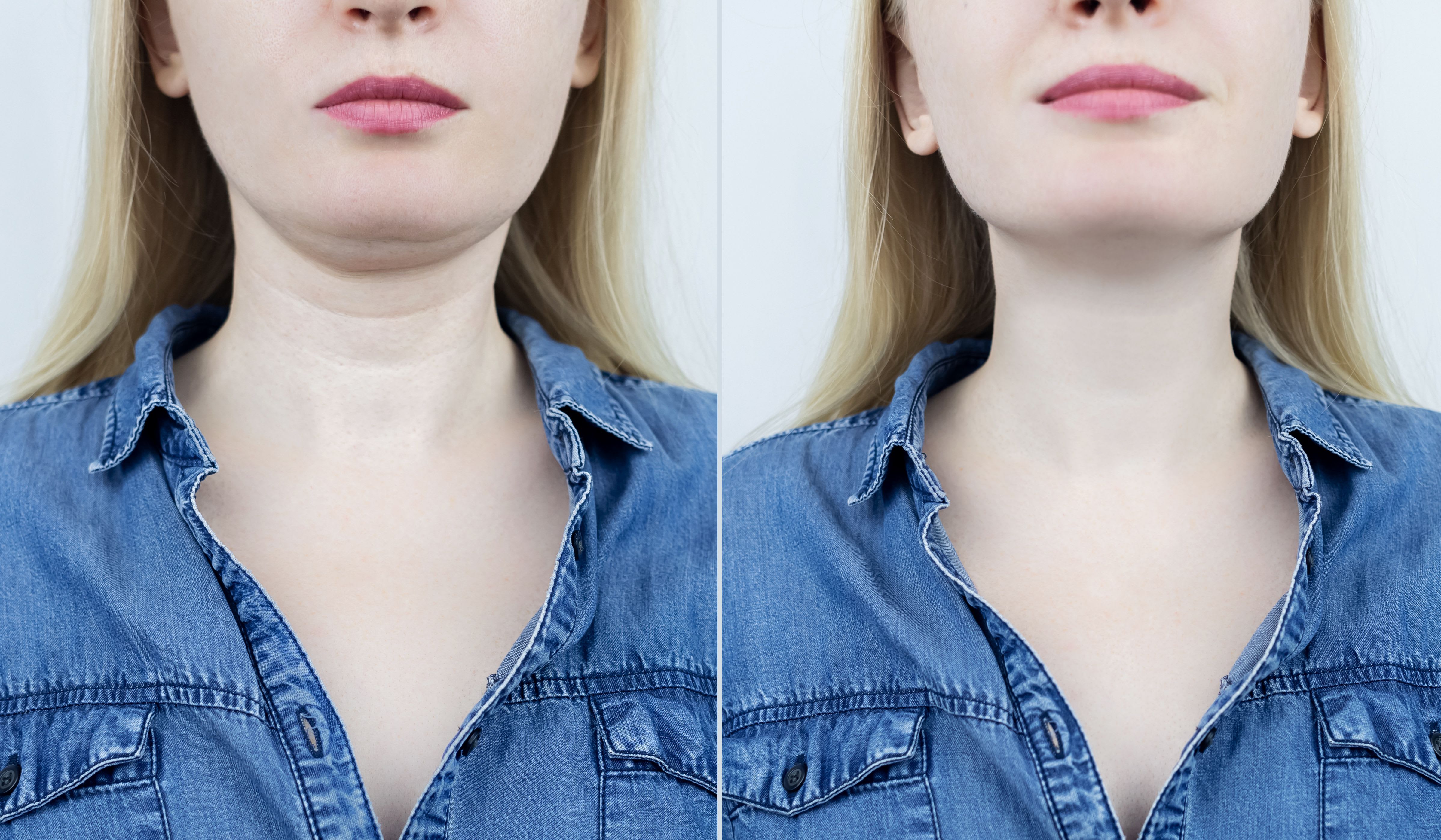 Lipo Dissolve -Chin - Lipo Dissolve (Liquid Lipo) Injections - Belle ...