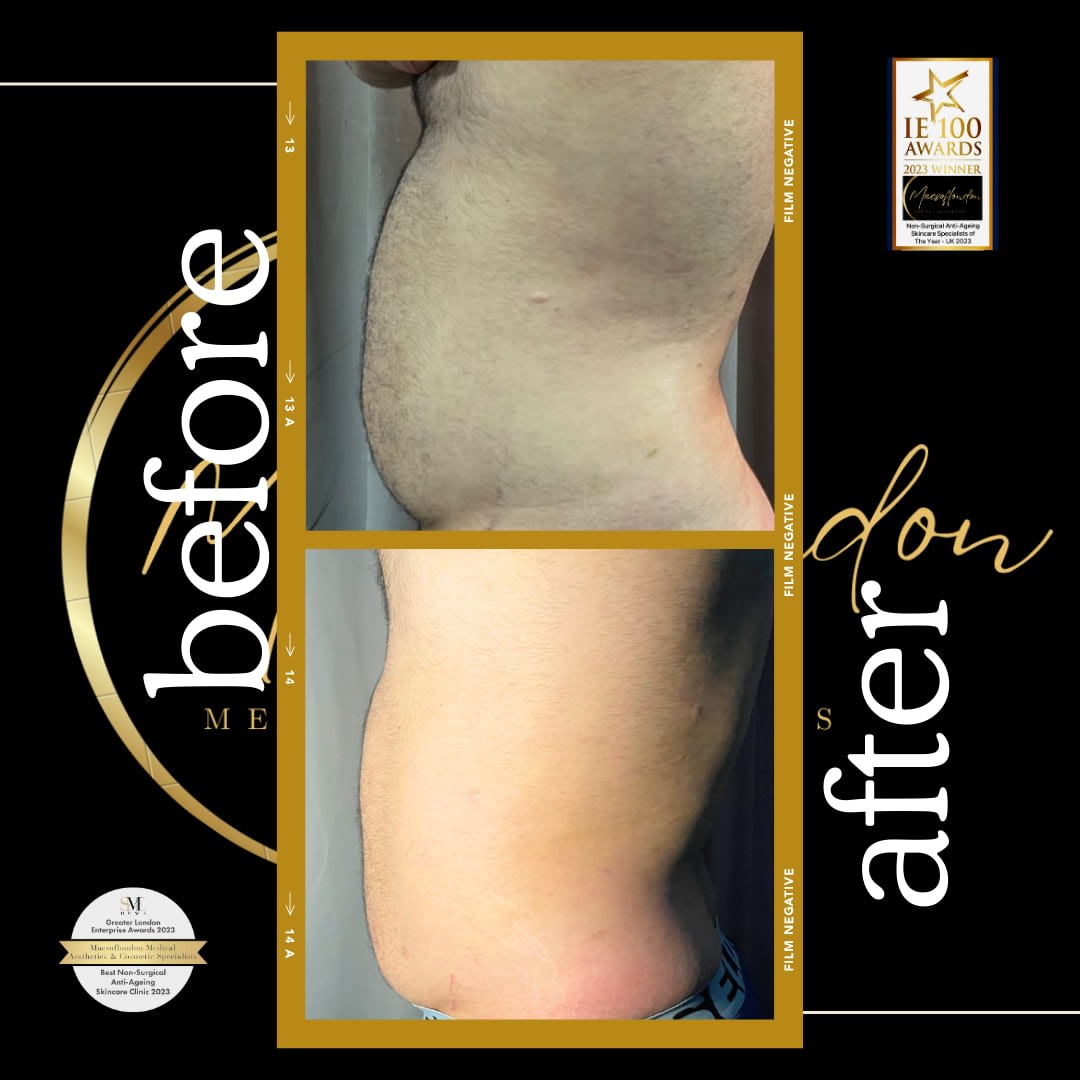 Fat Dissolving Injections - Lipolysis - Fat Dissolving - Lipolysis ...