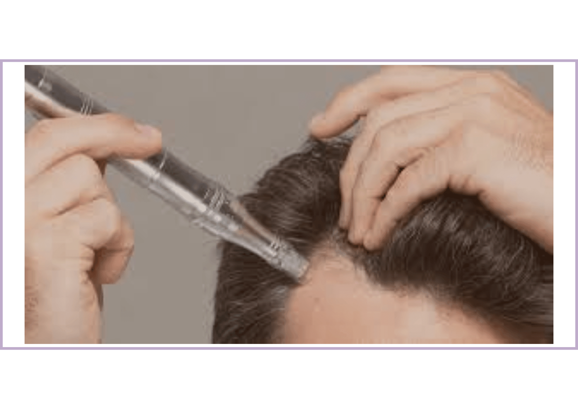 Hair Regrowth - Micro-Needling Treatments - Skin Serenity | Corrective ...
