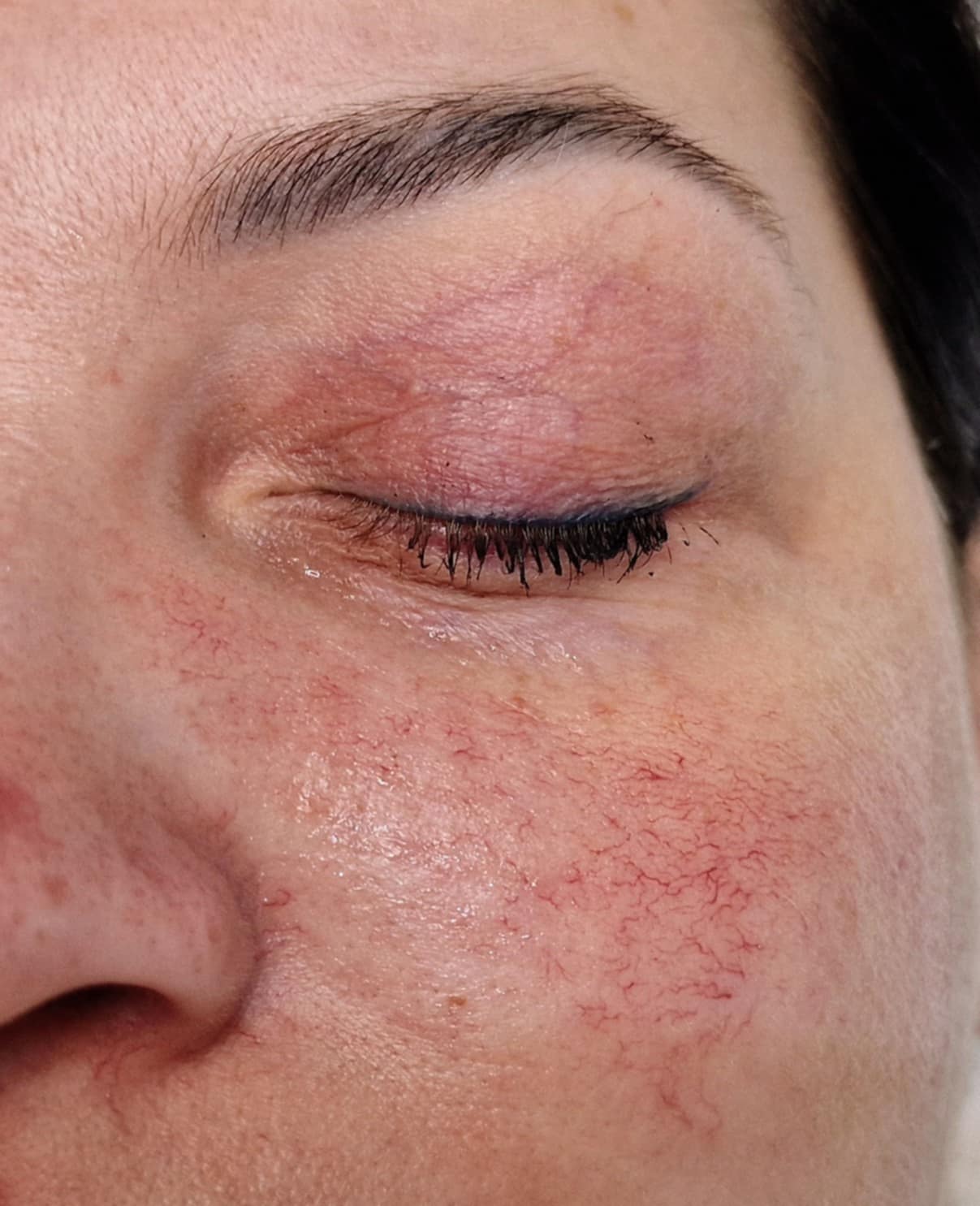 Cheeks only - Laser Thread Veins Removal - Vivi's Beauty Workshop ...