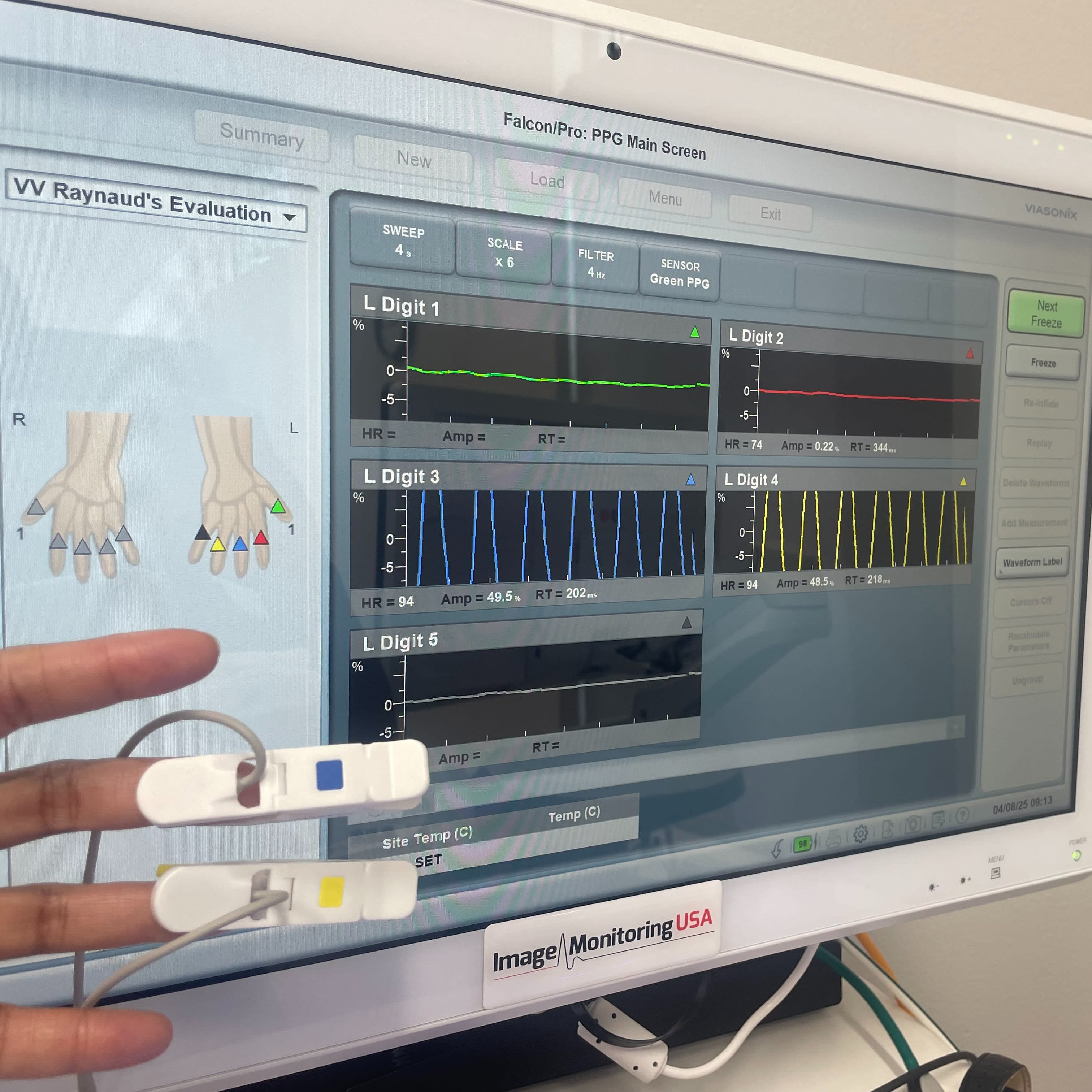 Raynaud Testing – Digital Blood Flow Evaluation