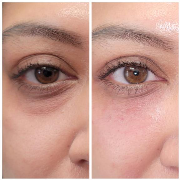 Under Eye Fillers - PRP Treatment - SoFlo Medical Center | Healthcare ...